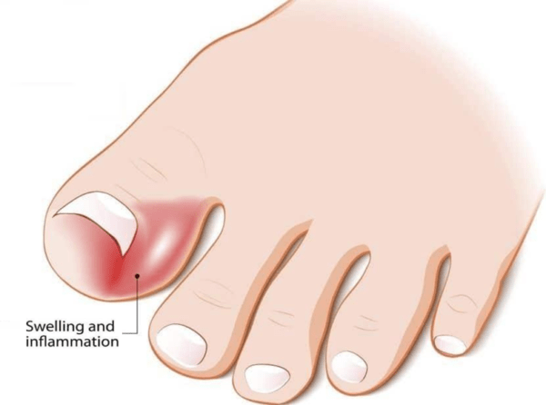 Ingrown Toenail Treatment | Bishopstown Podiatry Clinic