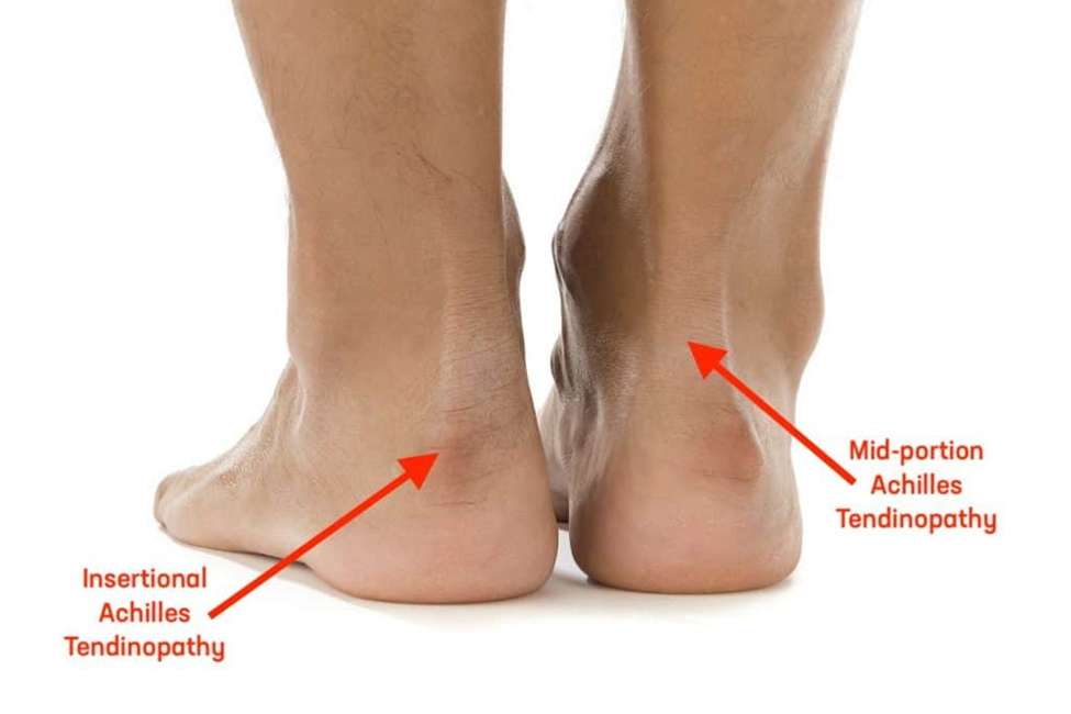 Achilles Tendinopathy Bishopstown Podiatry Clinic